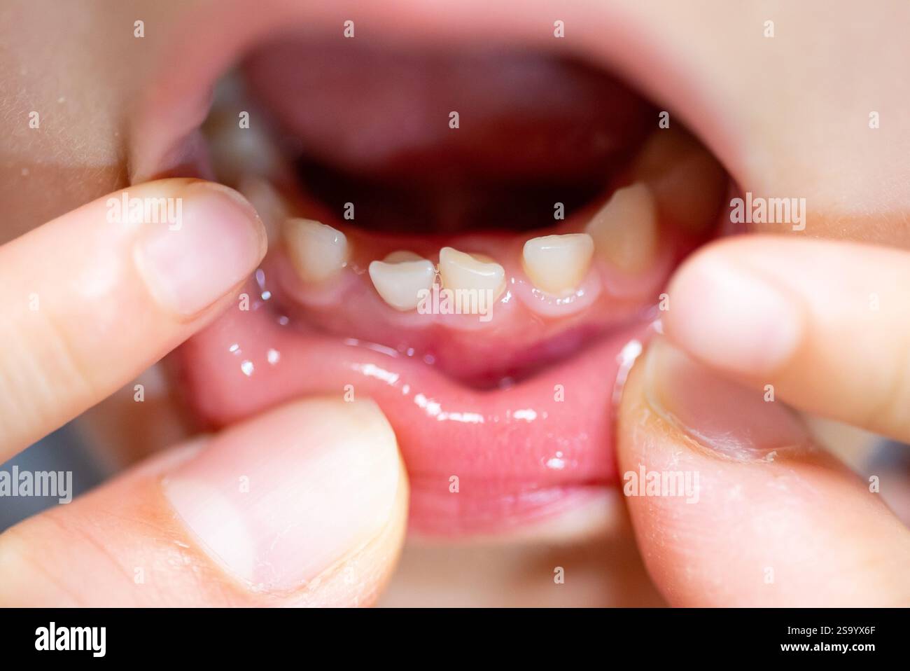 Wobbly child's front teeth (baby teeth Stock Photo - Alamy