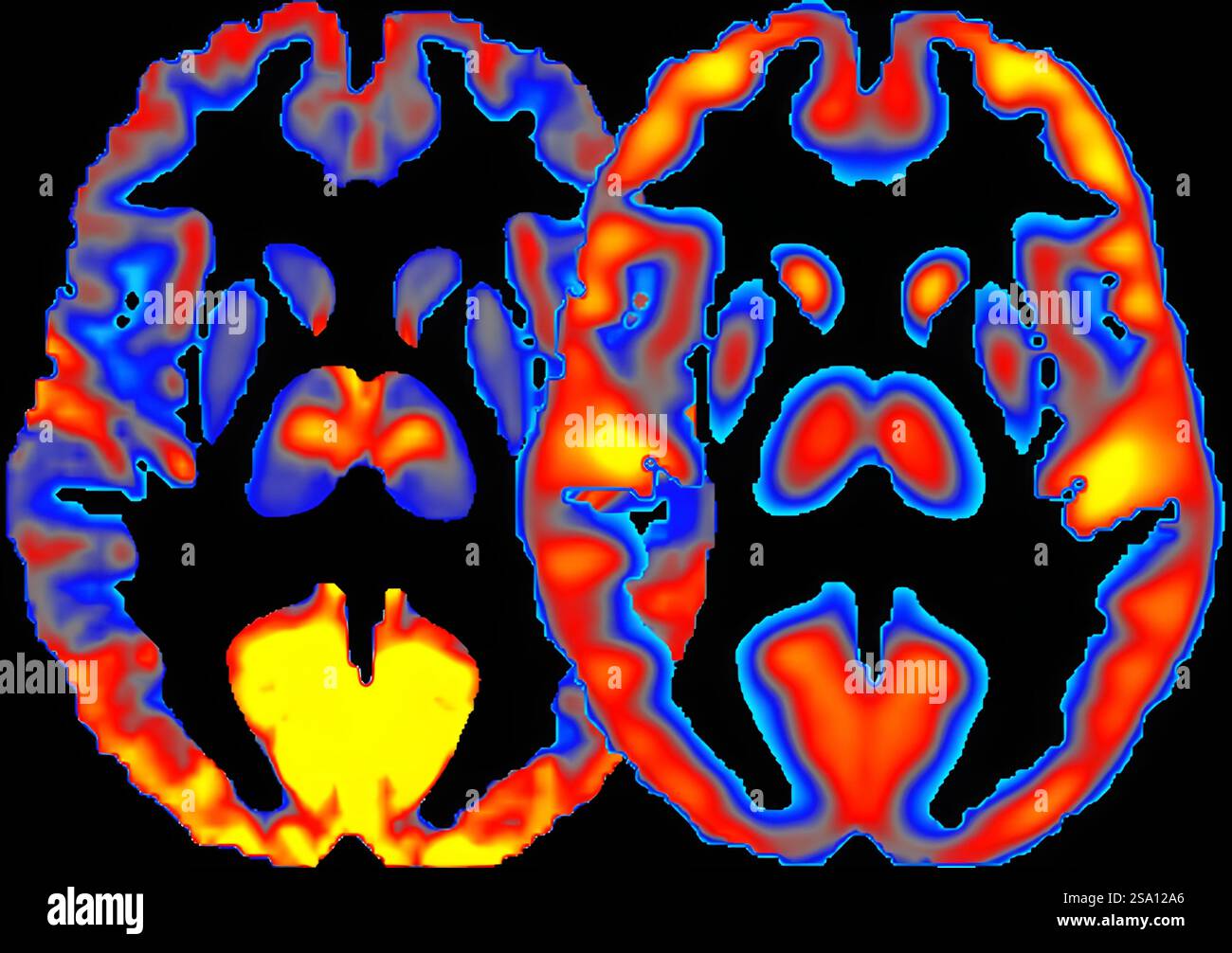 NIH scientists present a new method for combining measures of brain ...