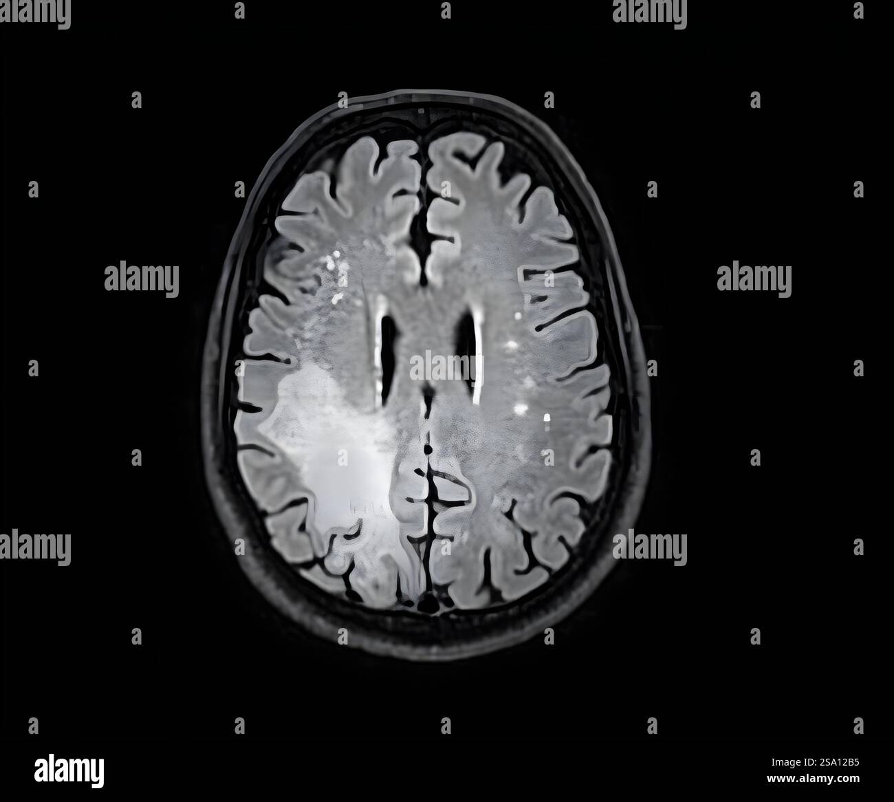 The anti-cancer drug pembrolizumab has shown promise in slowing or ...