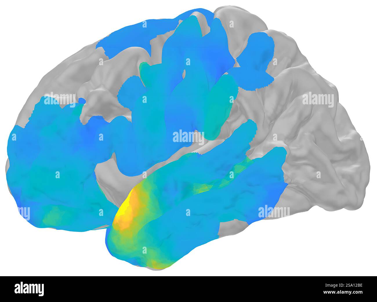 Epilepsy in human brain hi-res stock photography and images - Alamy