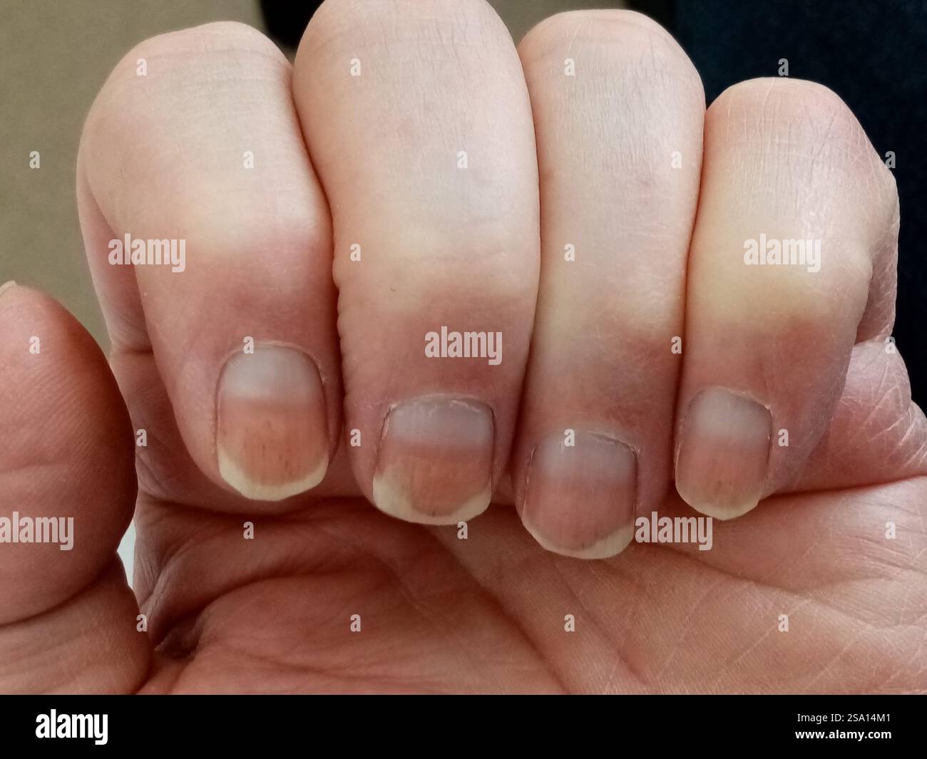 Blackened nails after chemotherapy Stock Photo - Alamy