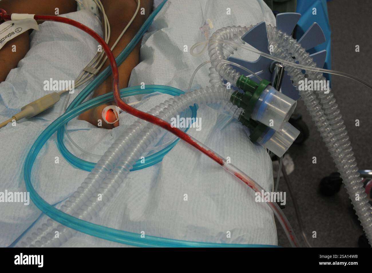 General anesthesia of a child in the operating room Stock Photo - Alamy