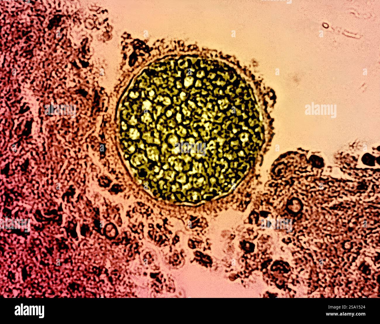 A Coccidioides fungal spherule (yellow) found in a tissue sample. This ...