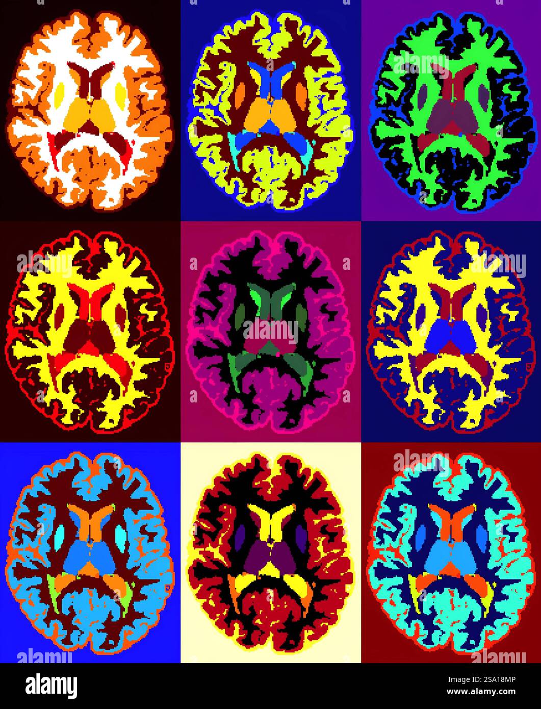 These are axial MRI scans of a person with multiple sclerosis that have ...