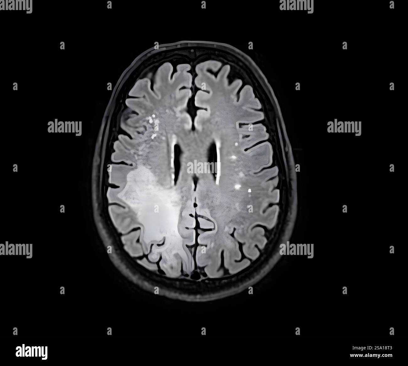 The anti-cancer drug pembrolizumab has shown promise in slowing or ...