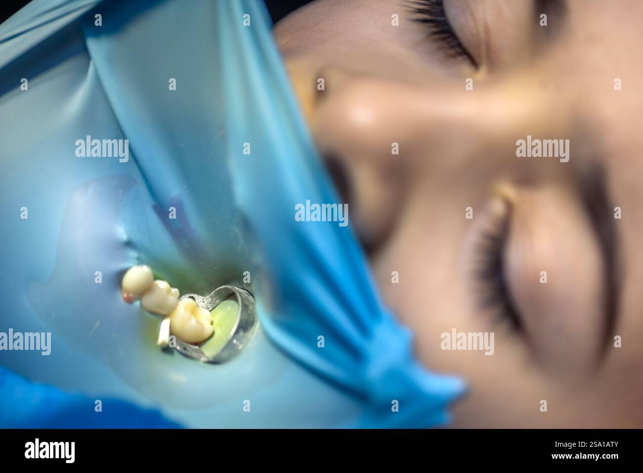 The dentist treats the child's tooth using a rubber dam. Close-up of ...