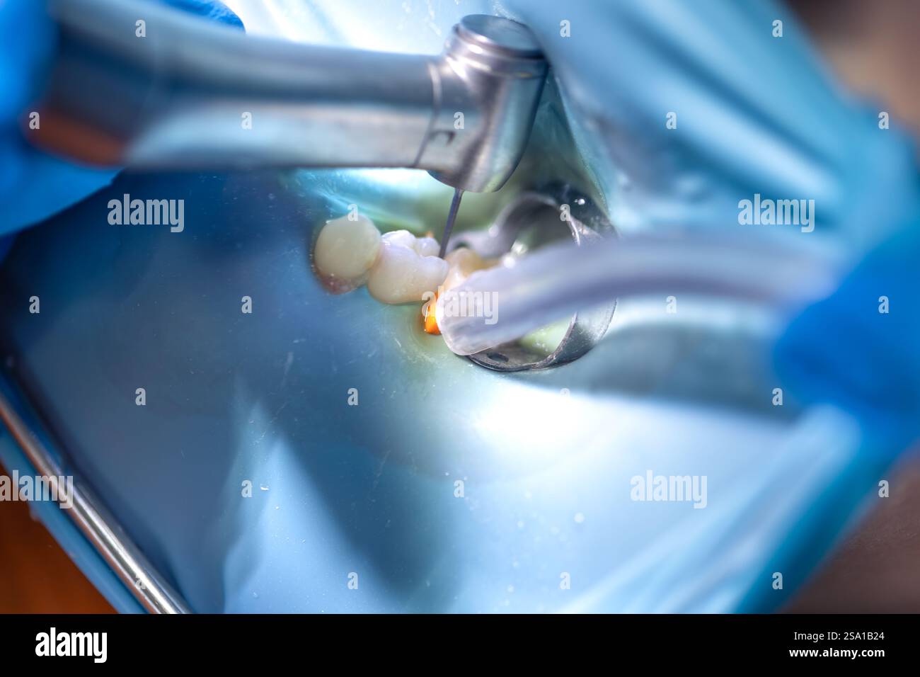 The dentist treats the child's tooth using a rubber dam. Close-up of ...