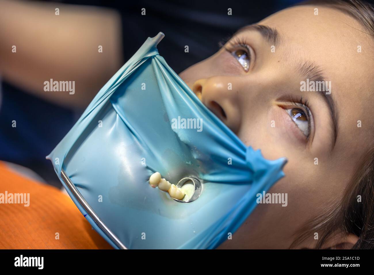 The dentist treats the child's tooth using a rubber dam. Close-up of ...