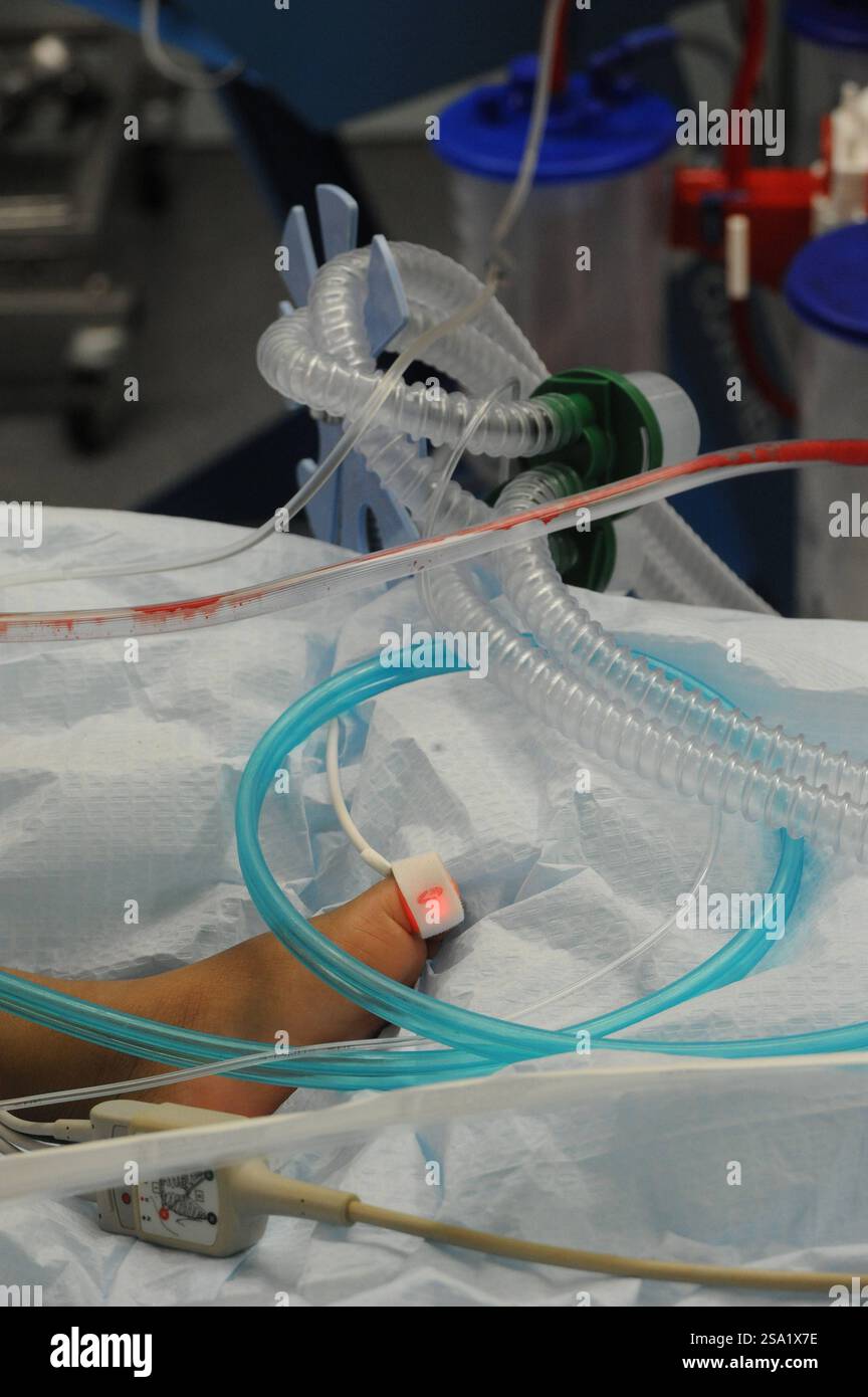 General anesthesia of a child in the operating room. Child anesthesia ...