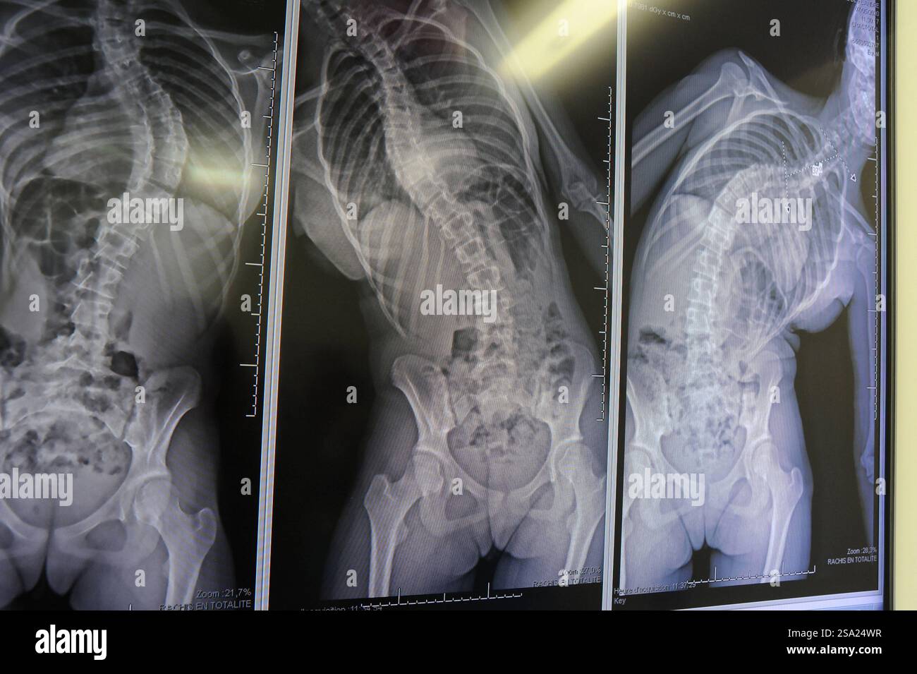 Severe scoliosis hi-res stock photography and images - Alamy