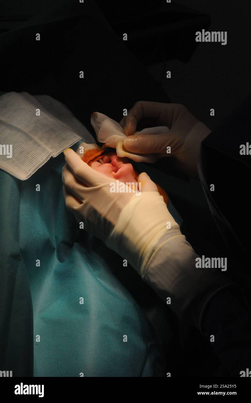 Cleft palate or harelip is a congenital malformation that will be ...