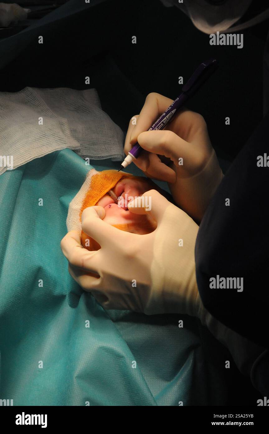 Cleft palate or harelip is a congenital malformation that will be ...