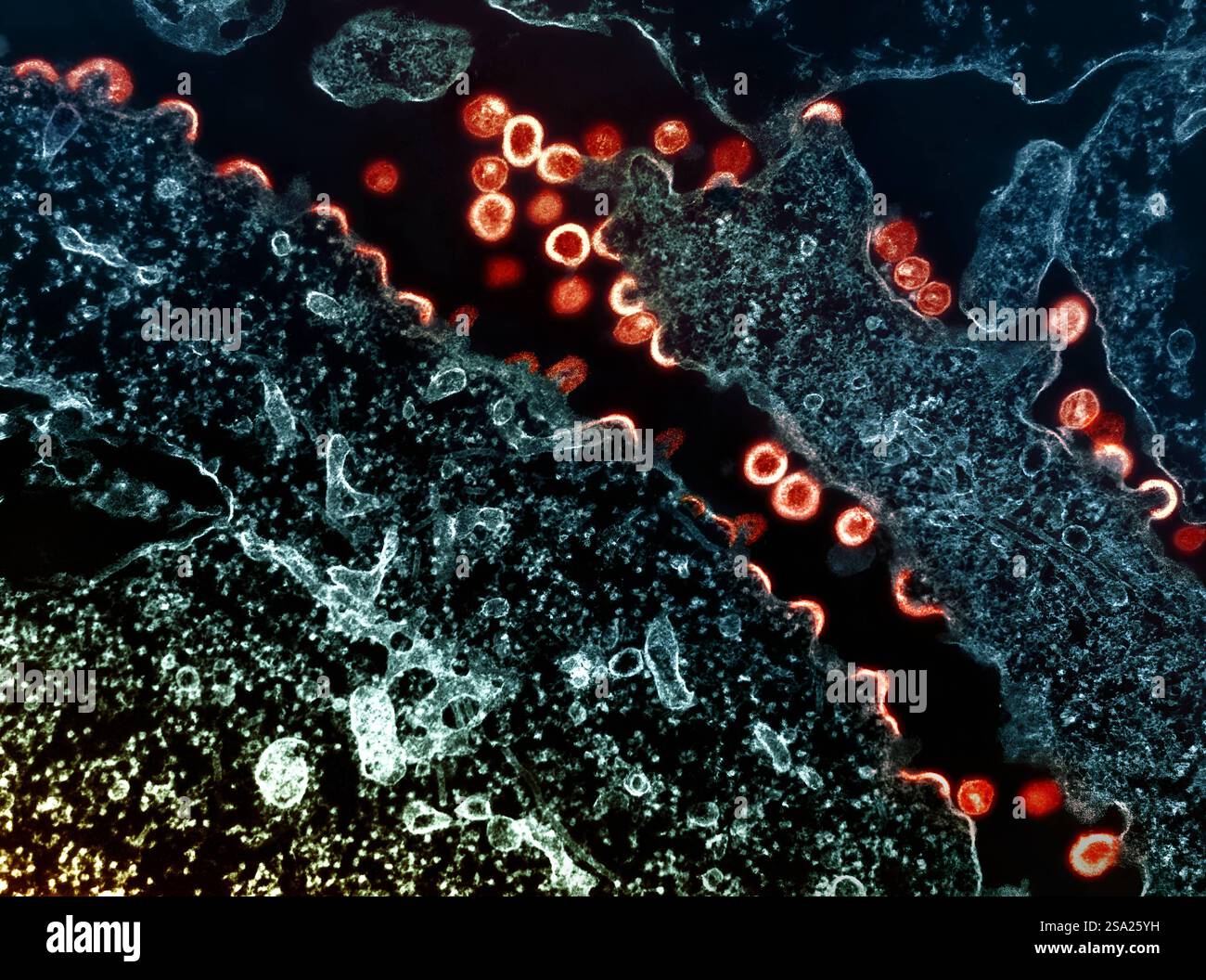 Transmission electron micrograph of HIV-1 virus particles red/yellow ...