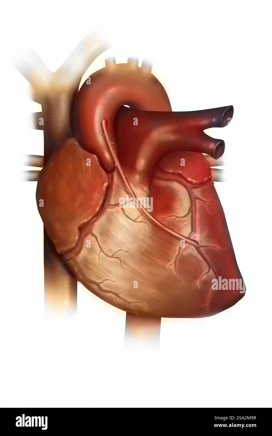 Coronary artery bypass grafting Stock Photo - Alamy