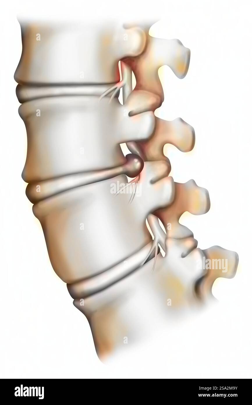 Herniated disc. A herniated disc is a protrusion of an intervertebral ...