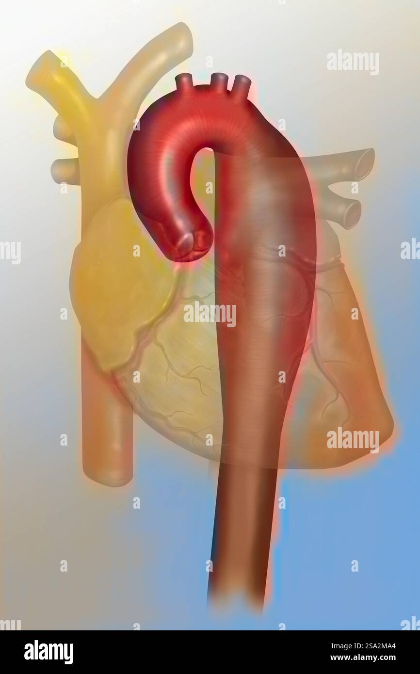 Aneurysm of the descending thoracic aorta Stock Photo - Alamy
