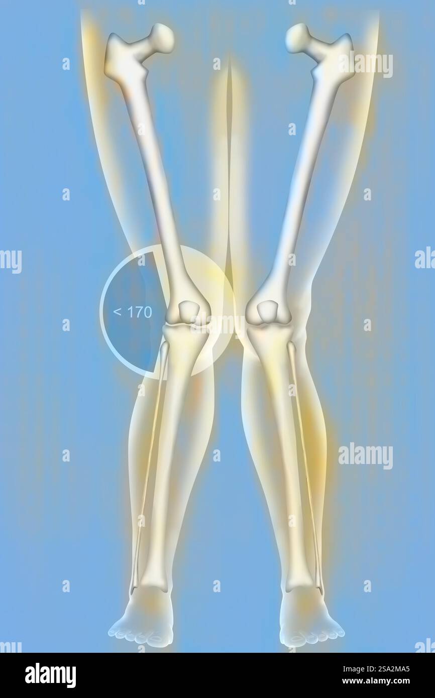 Genu valgum (knock knees). Genu valgum is a deformity of the lower limb ...