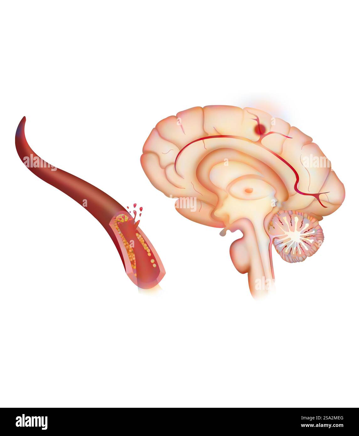 Depiction of an ischemic stroke, or cerebrovascular accident (CVA Stock ...