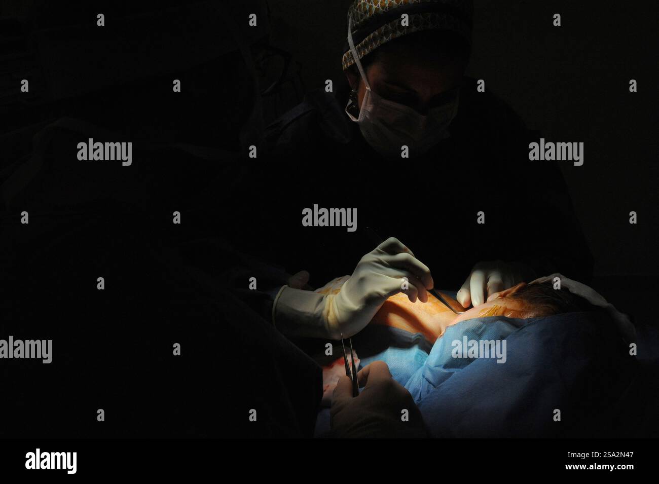 Skin grafting hi-res stock photography and images - Alamy