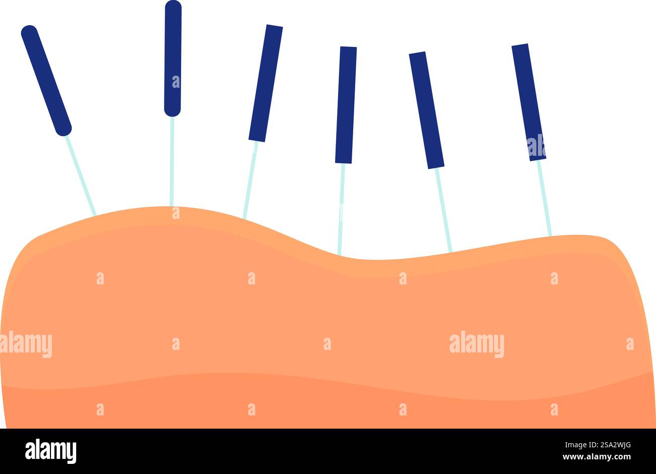 Illustration of acupuncture needles placement for therapeutic ...