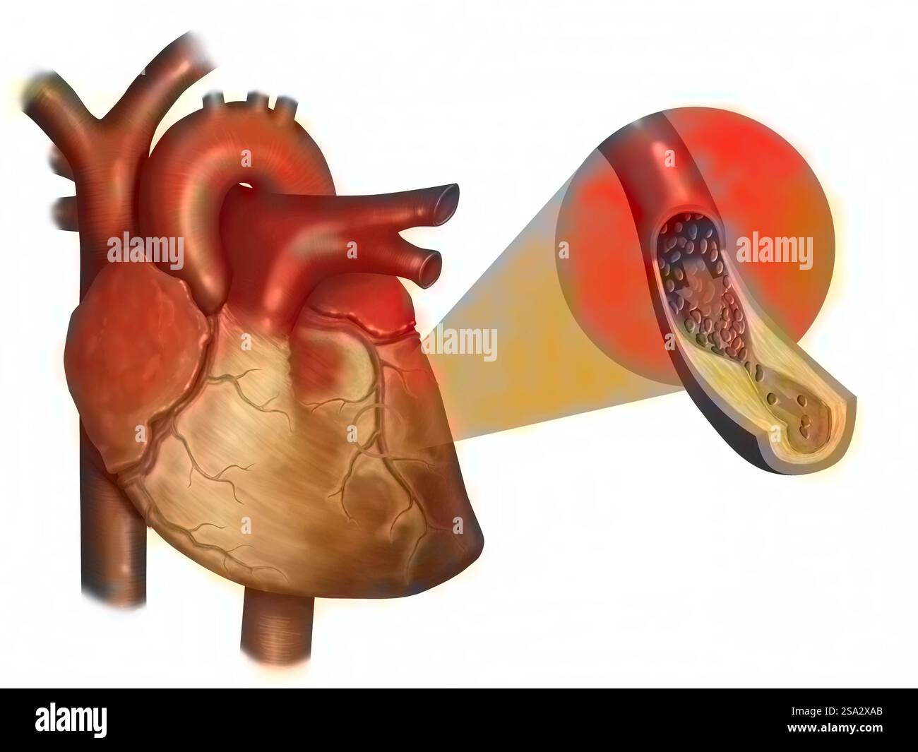 Myocardial infarction atheroma plaque. A myocardial infarction is a ...