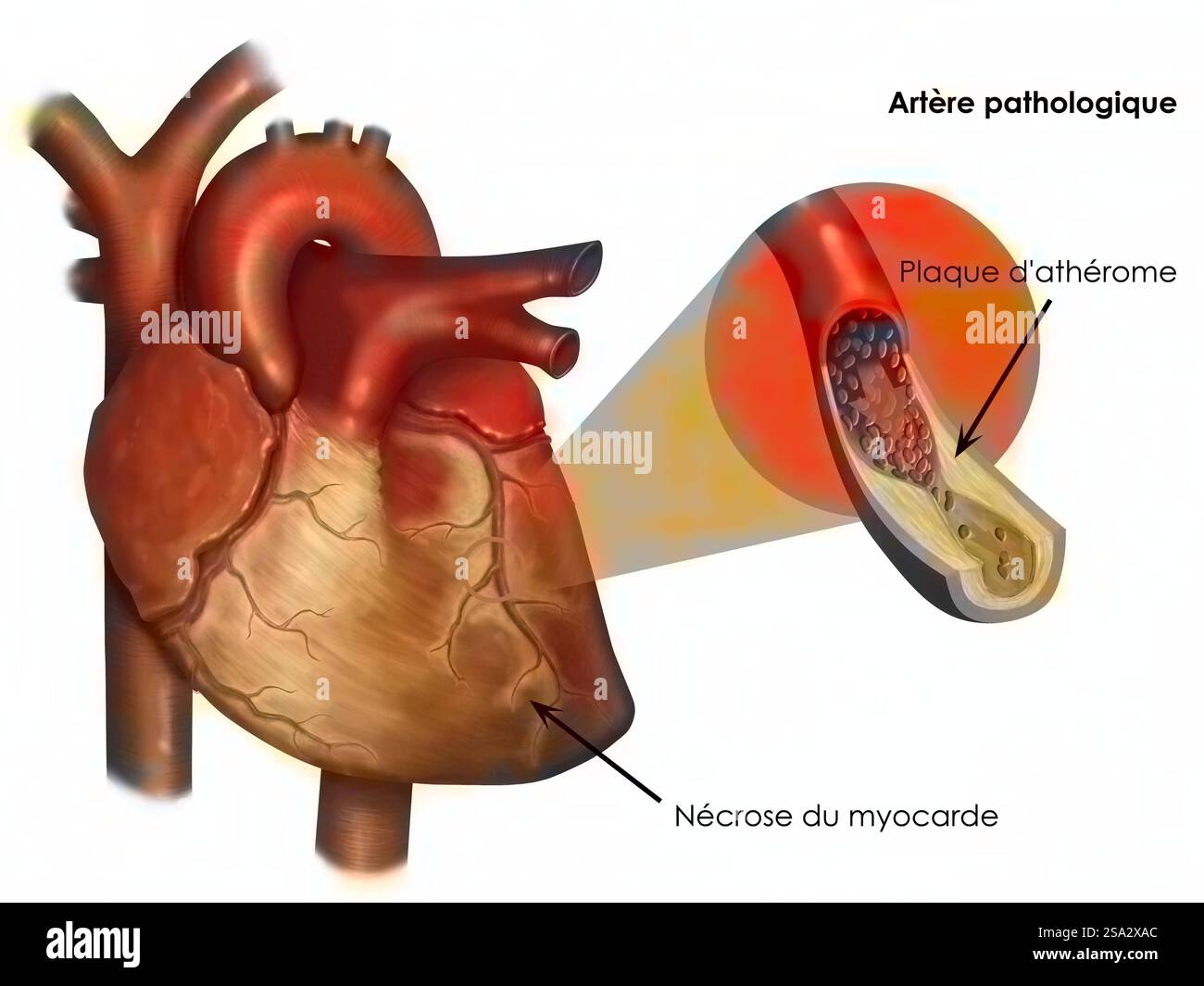 Myocardial infarction atheroma plaque. A myocardial infarction is a ...