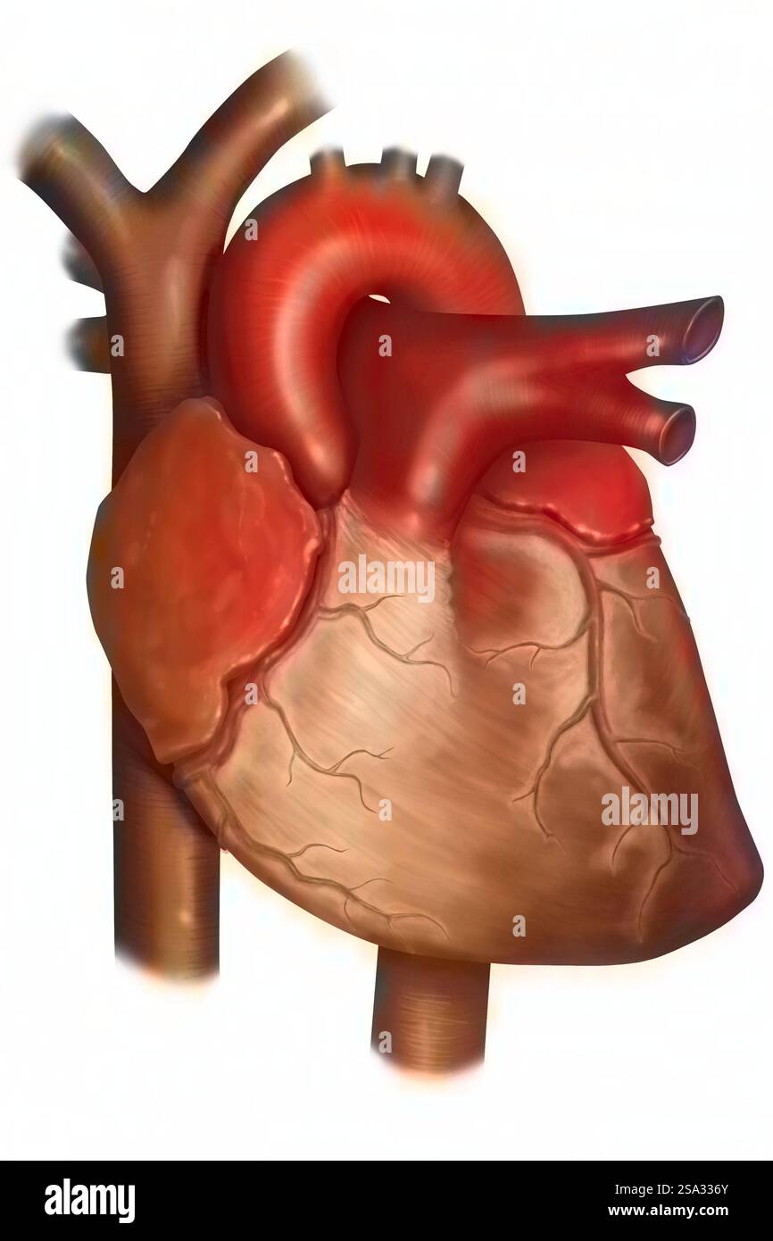 Myocardial infarction. Myocardial infarction is a necrosis of a part of ...