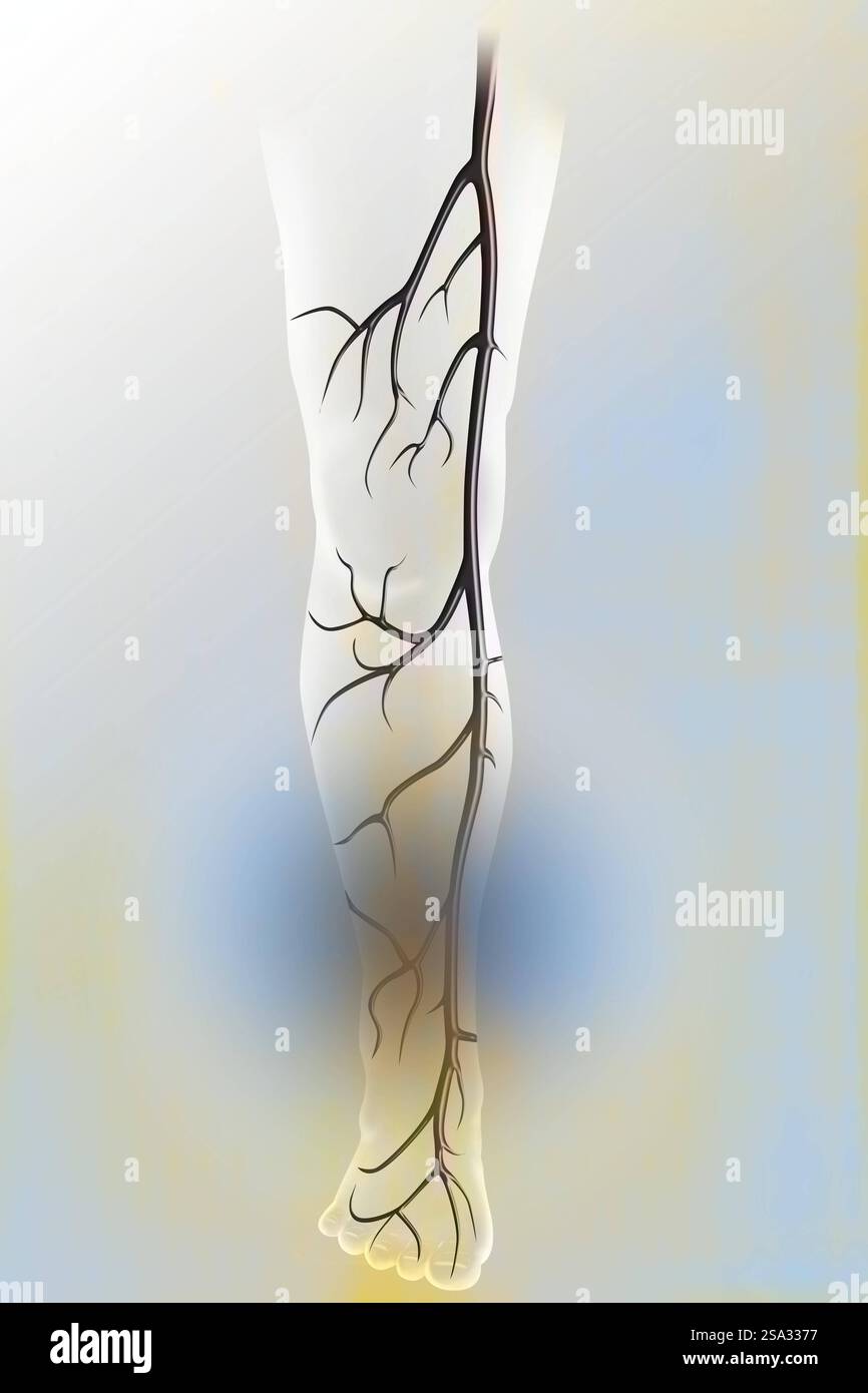 Illustration of leg pain, and more particularly venous insufficiency ...