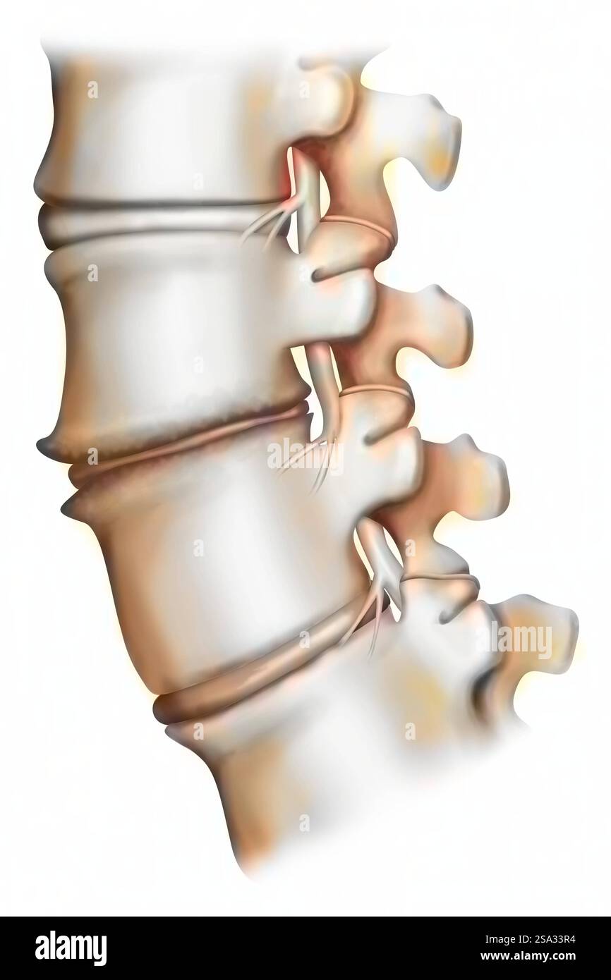 Spondyloarthrosis of the lumbar vertebrae lumbar osteoarthritis, with ...