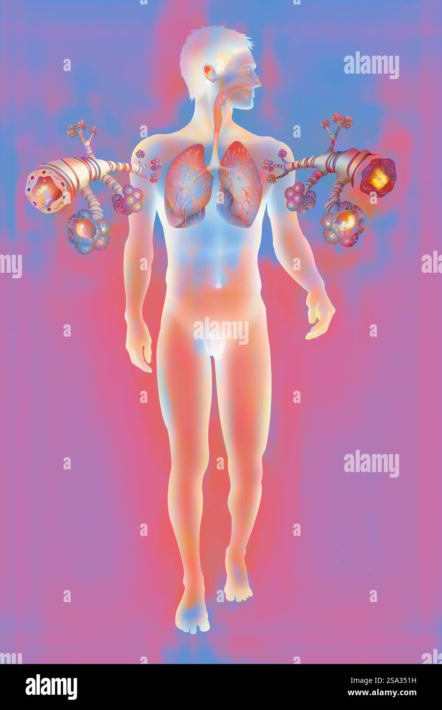 Depiction of a healthy bronchial tube left and a bronchial tube during ...