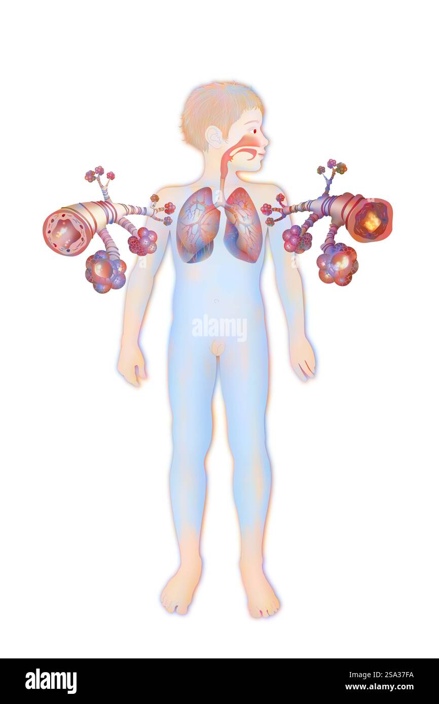 Depiction of a healthy bronchial tube left and a bronchial tube during ...
