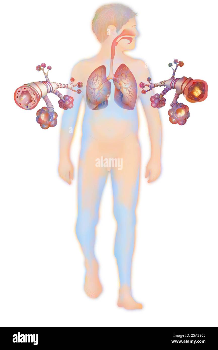 Depiction of a healthy bronchial tube left and a bronchial tube during ...