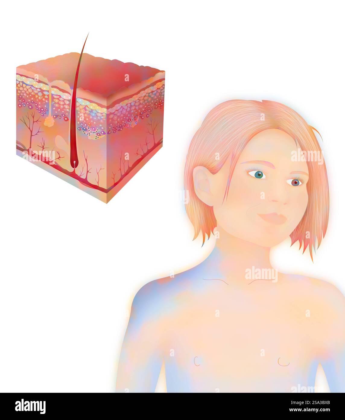 Sunburn, drawing Sunburn, drawing 016889 237 Stock Photo - Alamy