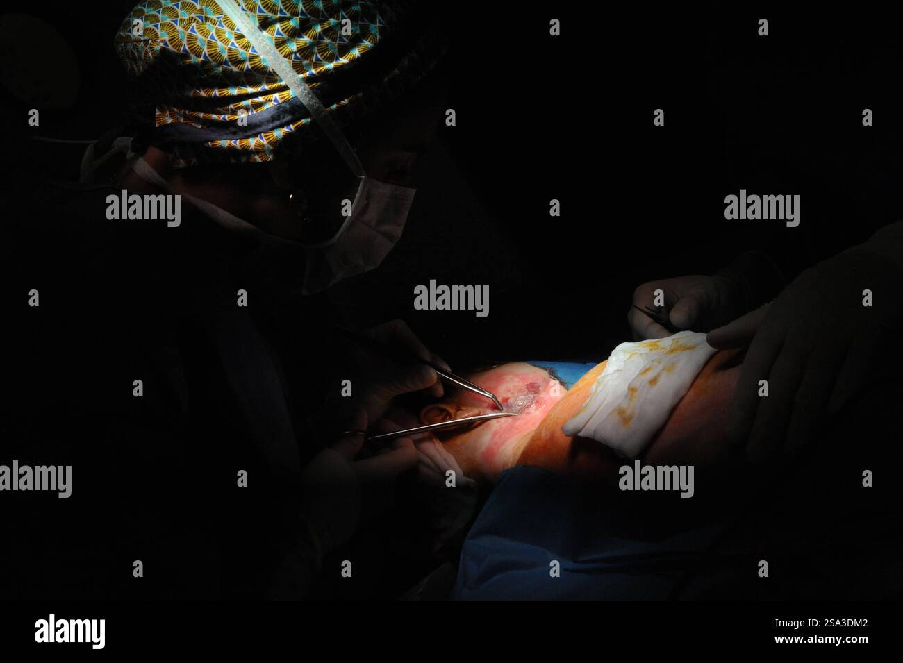 Skin grafting in an operating room. Skin grafting 016921 003 Stock ...