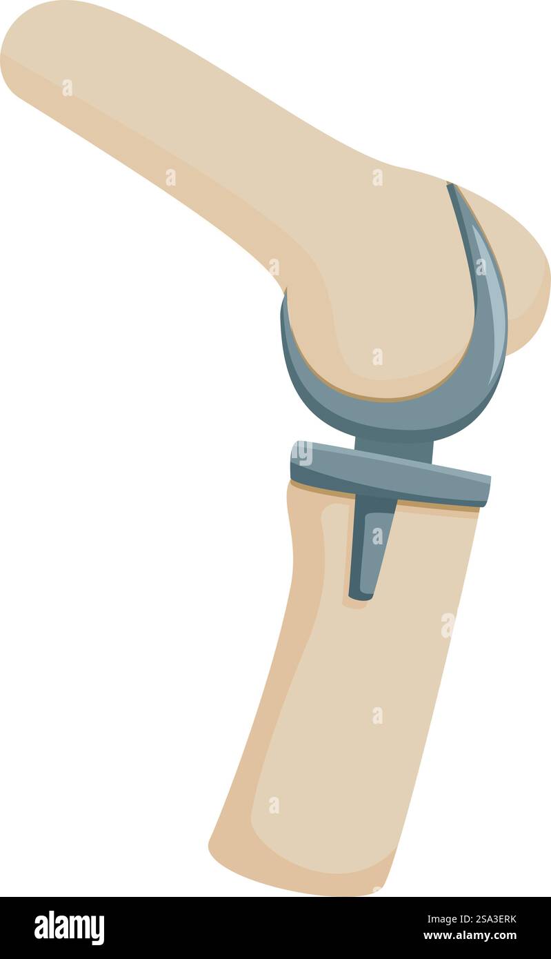 Vector illustration of a modern prosthetic knee joint, isolated on a ...