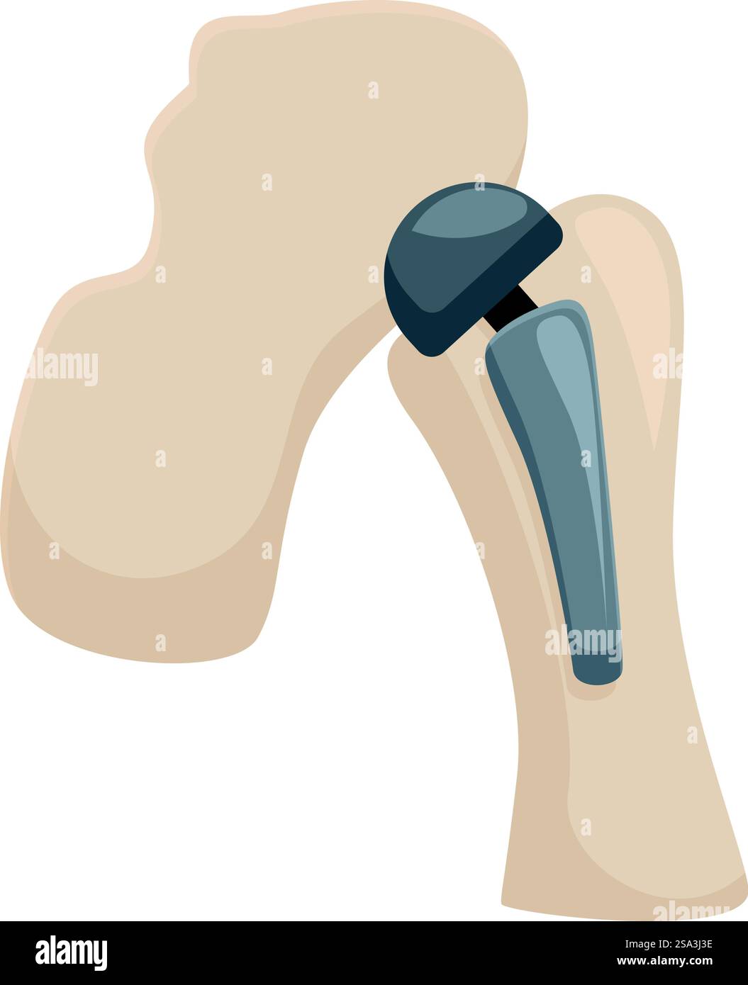 Vector graphic of a hip joint replacement, showcasing a medical ...