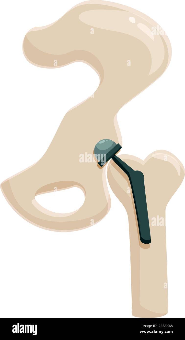 Detailed vector graphic of a hip prosthesis implanted in a femur bone ...