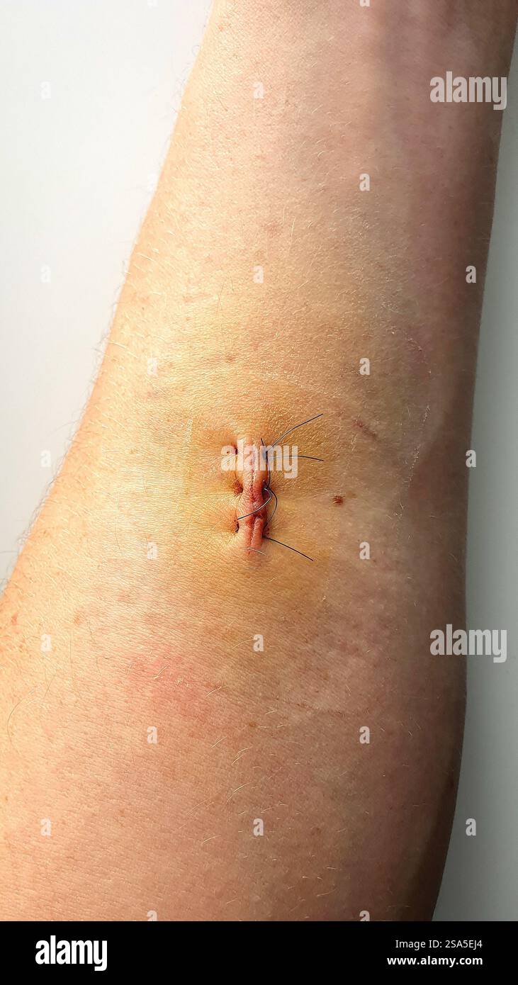 Hand after surgery. Stitched injury with scar. Lipoma removal Stock ...