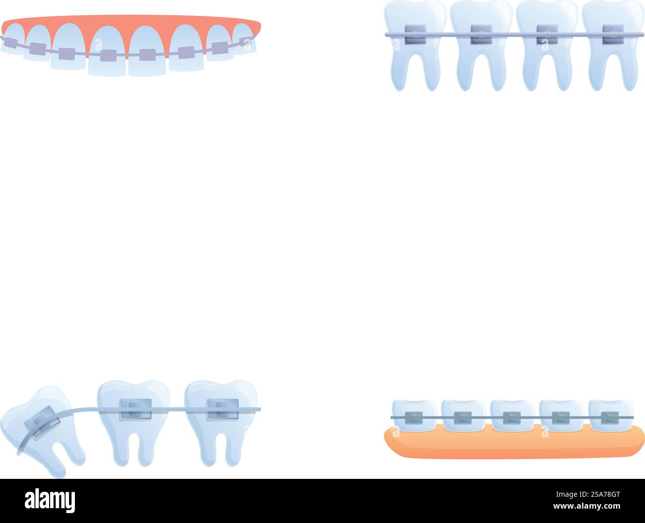 Bite correction icons set cartoon vector. Orthodontic brace system on ...