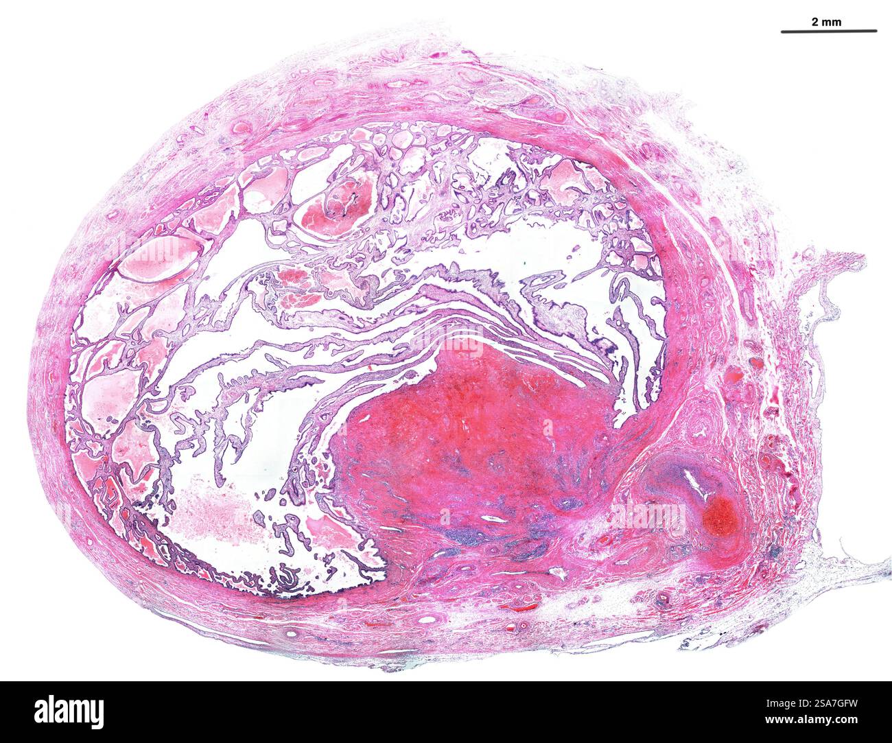 Ectopic pregnancy in human fallopian tube. Light micrograph showing an ...