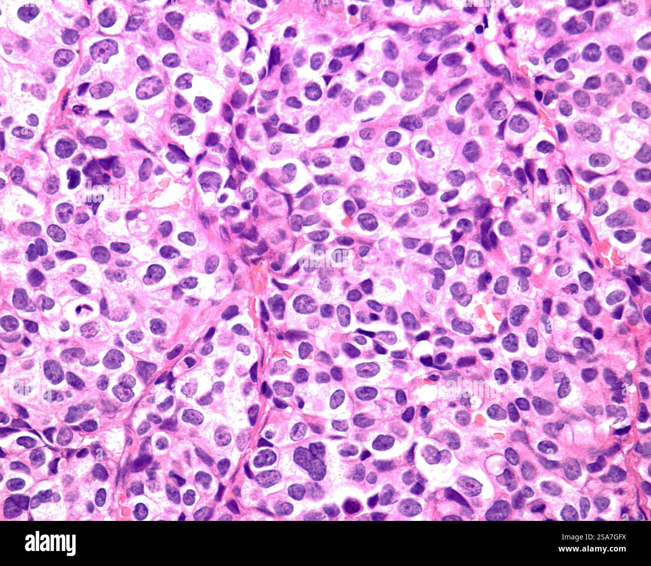 Light micrograph of an anaplastic or undifferentiated liver carcinoma ...