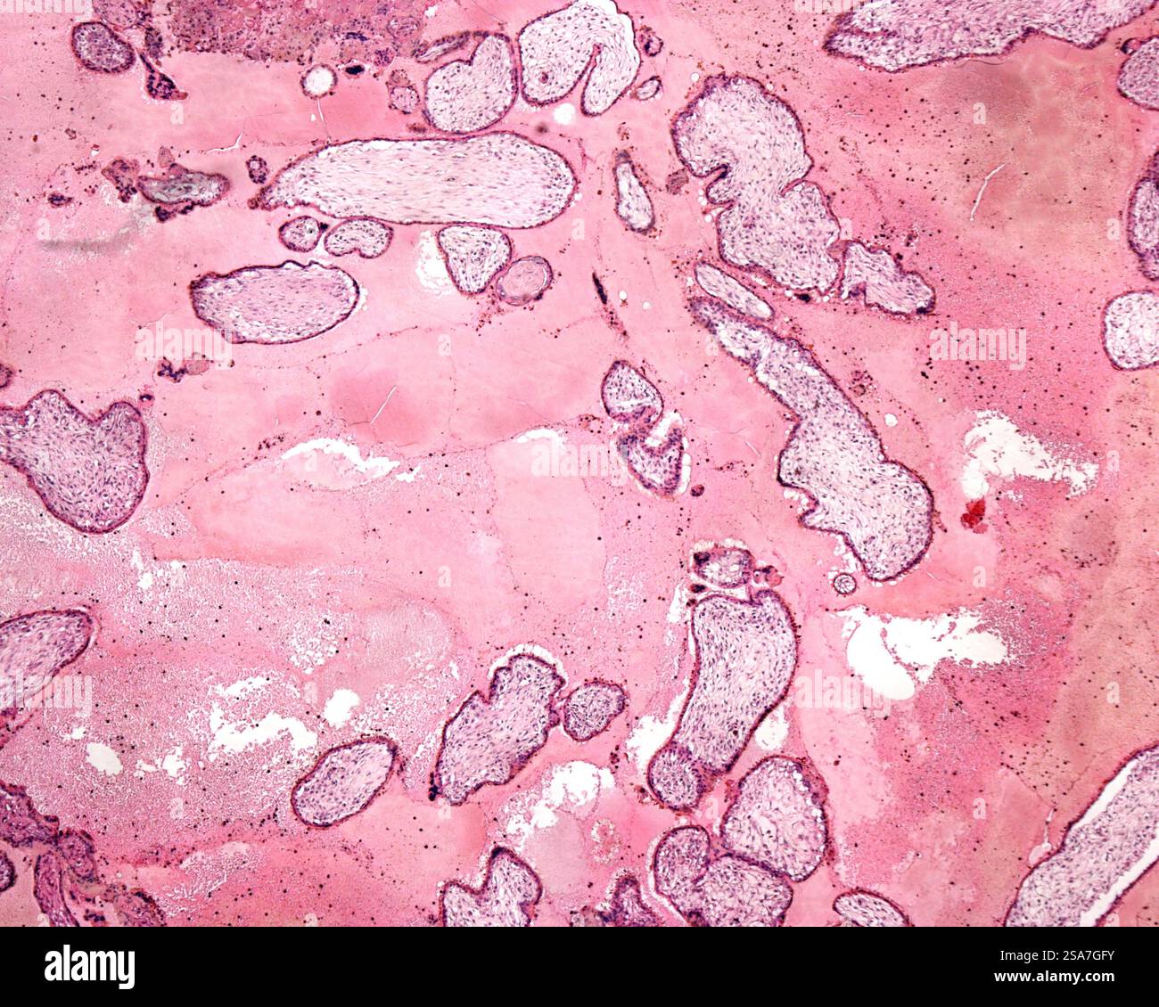 Mole of Breus in human placenta, light micrograph. A Breus' mole is a ...
