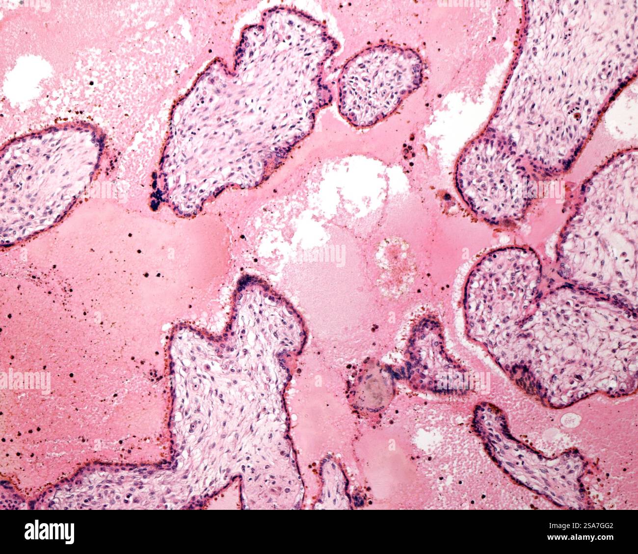 Mole of Breus in human placenta, light micrograph. A Breus' mole is a ...