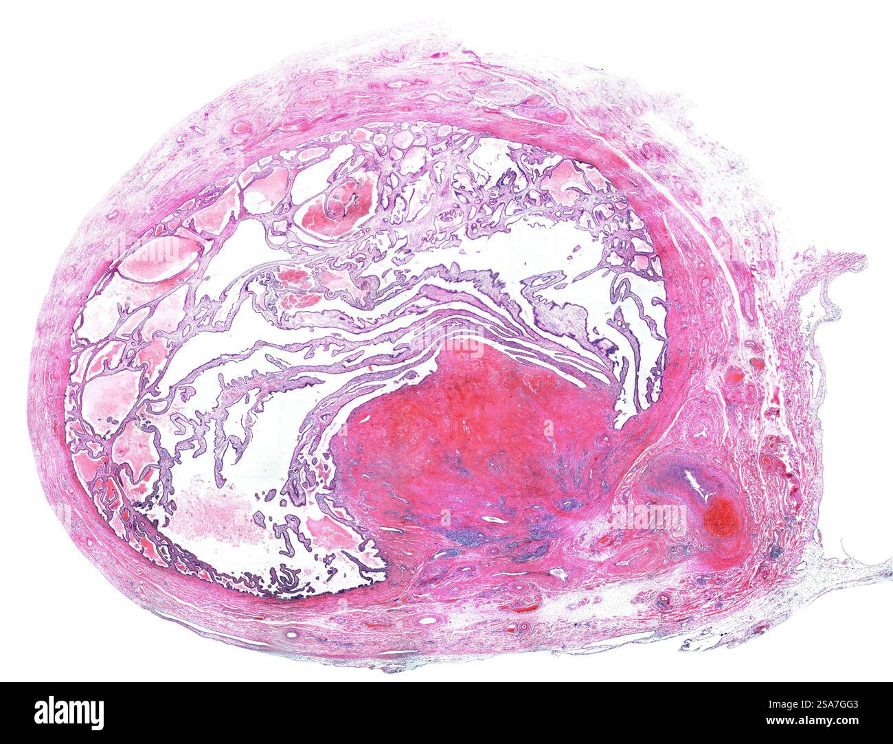 Ectopic pregnancy in human fallopian tube. Light micrograph showing an ...