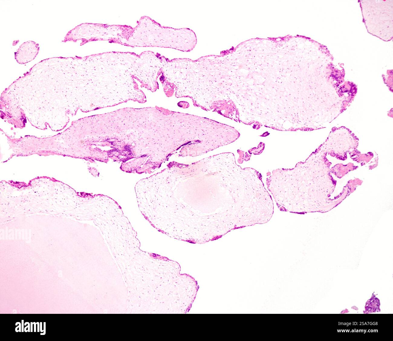 Hydatidiform mole, light micrograph. A hydatidiform mole is an abnormal ...