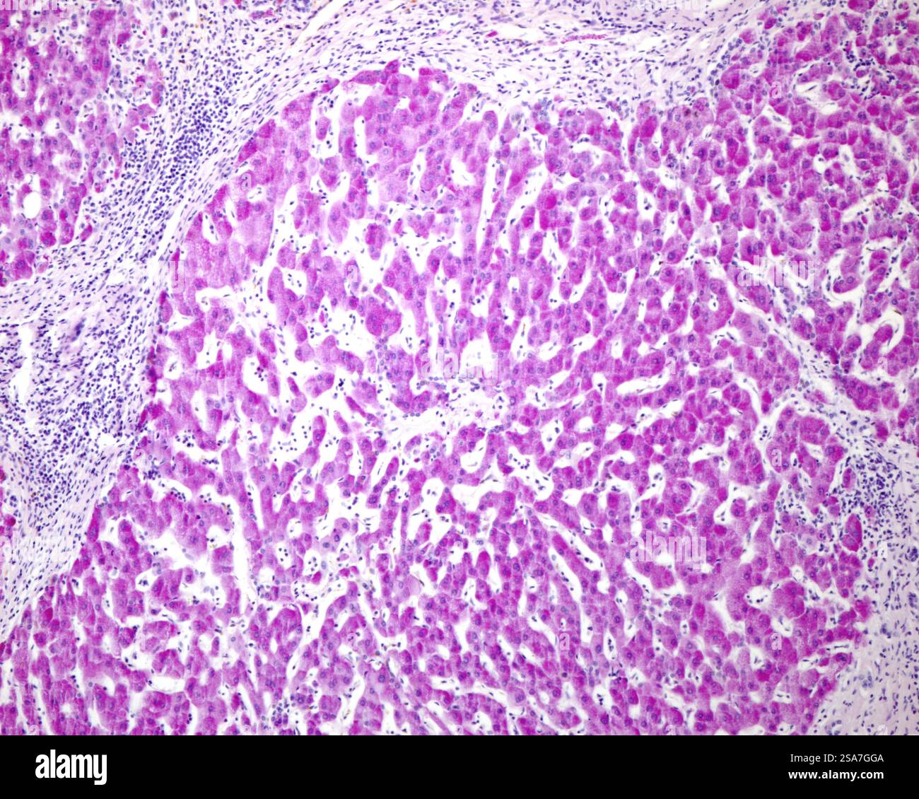 Light micrograph of a human liver with cirrhosis stained with the ...