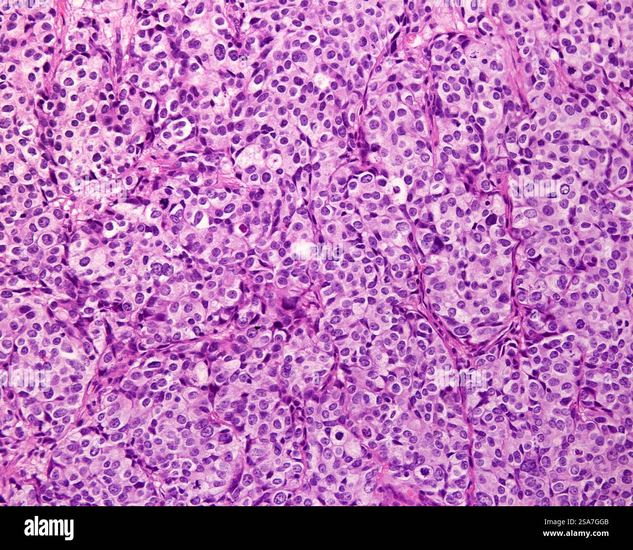 Light micrograph of human live tissue showing an anaplastic, or ...