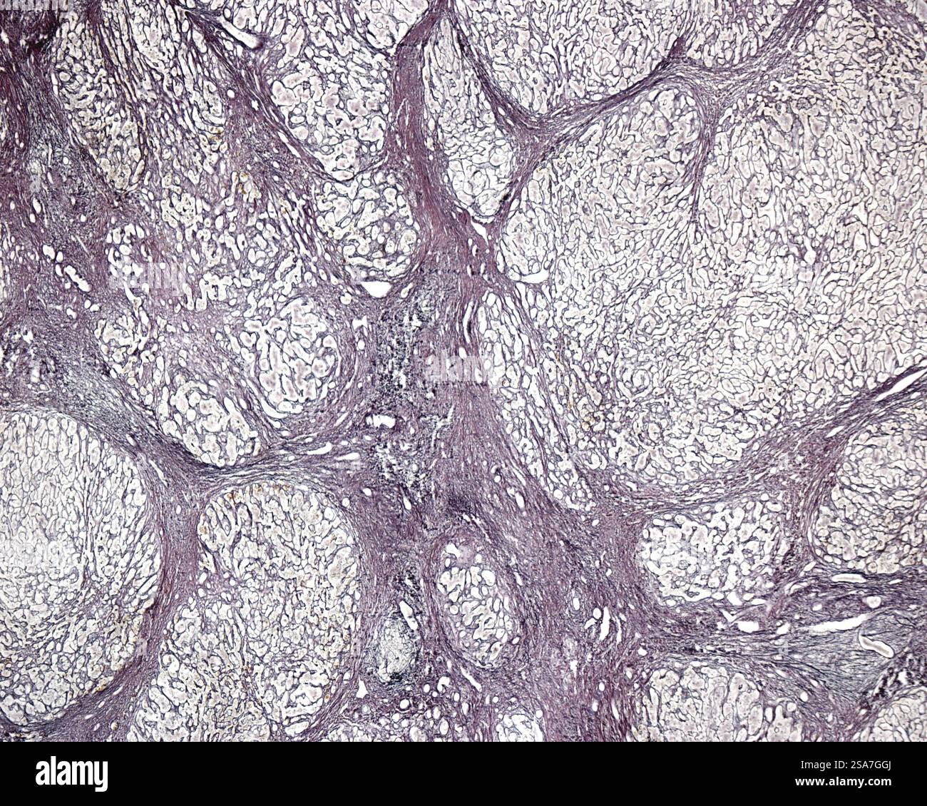 Light micrograph of a human liver with micronodular cirrhosis, a ...