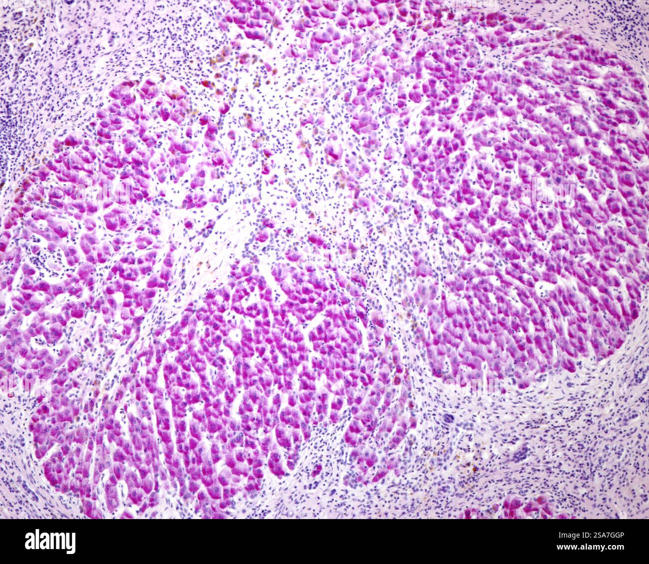 Light micrograph of a human liver with cirrhosis stained with the ...