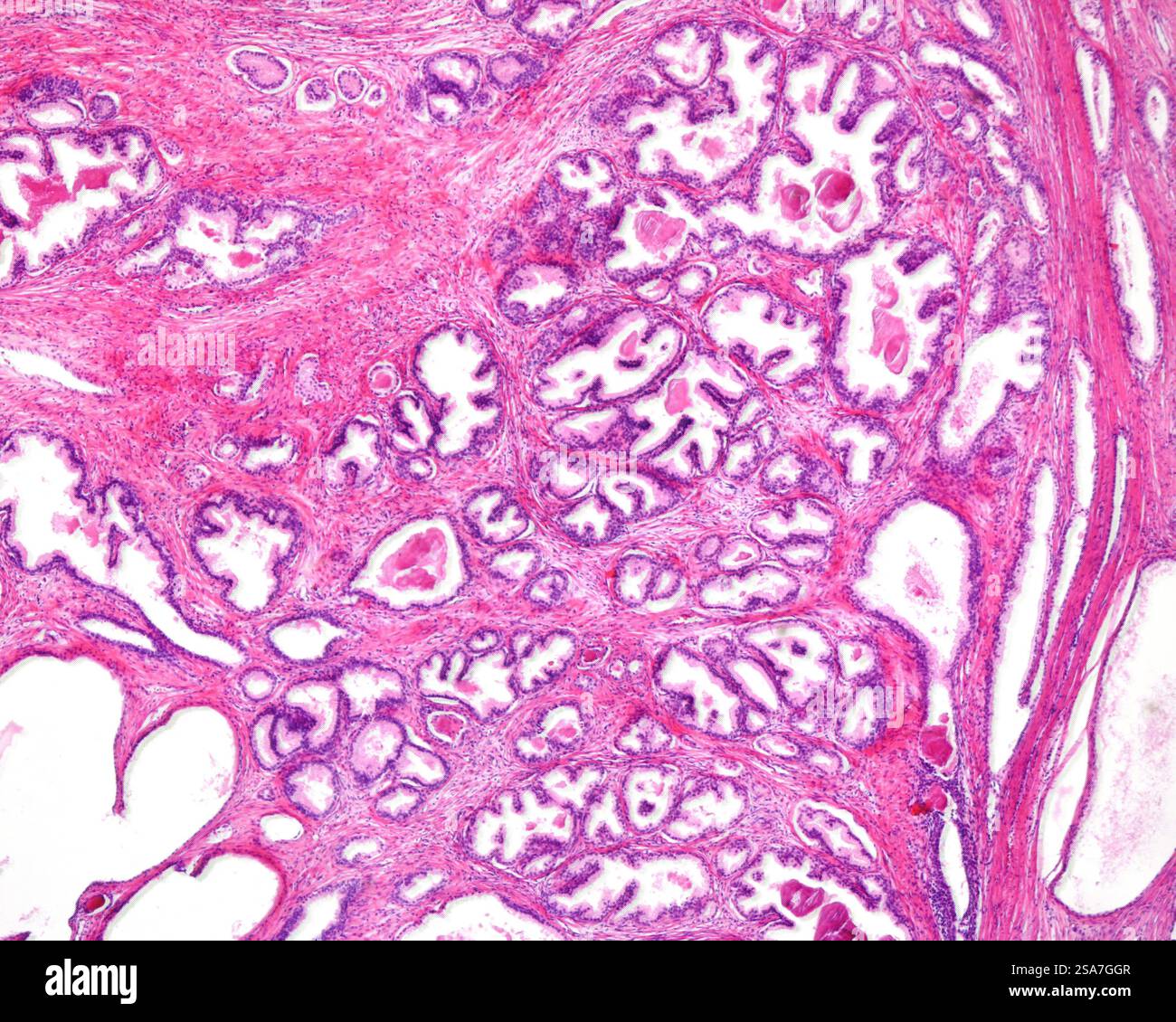 Light micrograph showing a human prostate with benign prostatic ...
